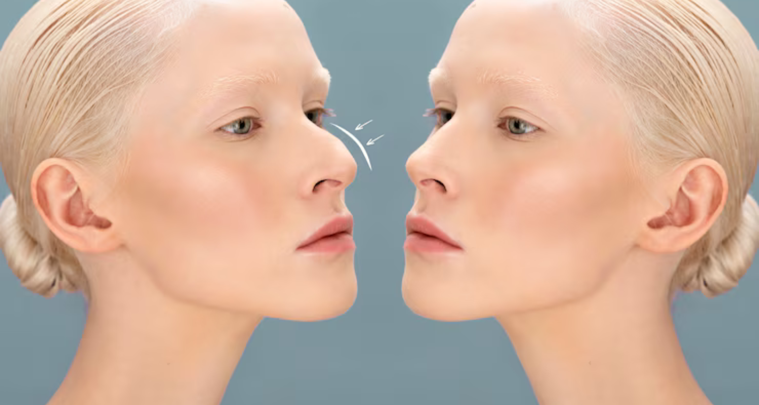 Nose Thread Lift: Results Timeline and What to Expect